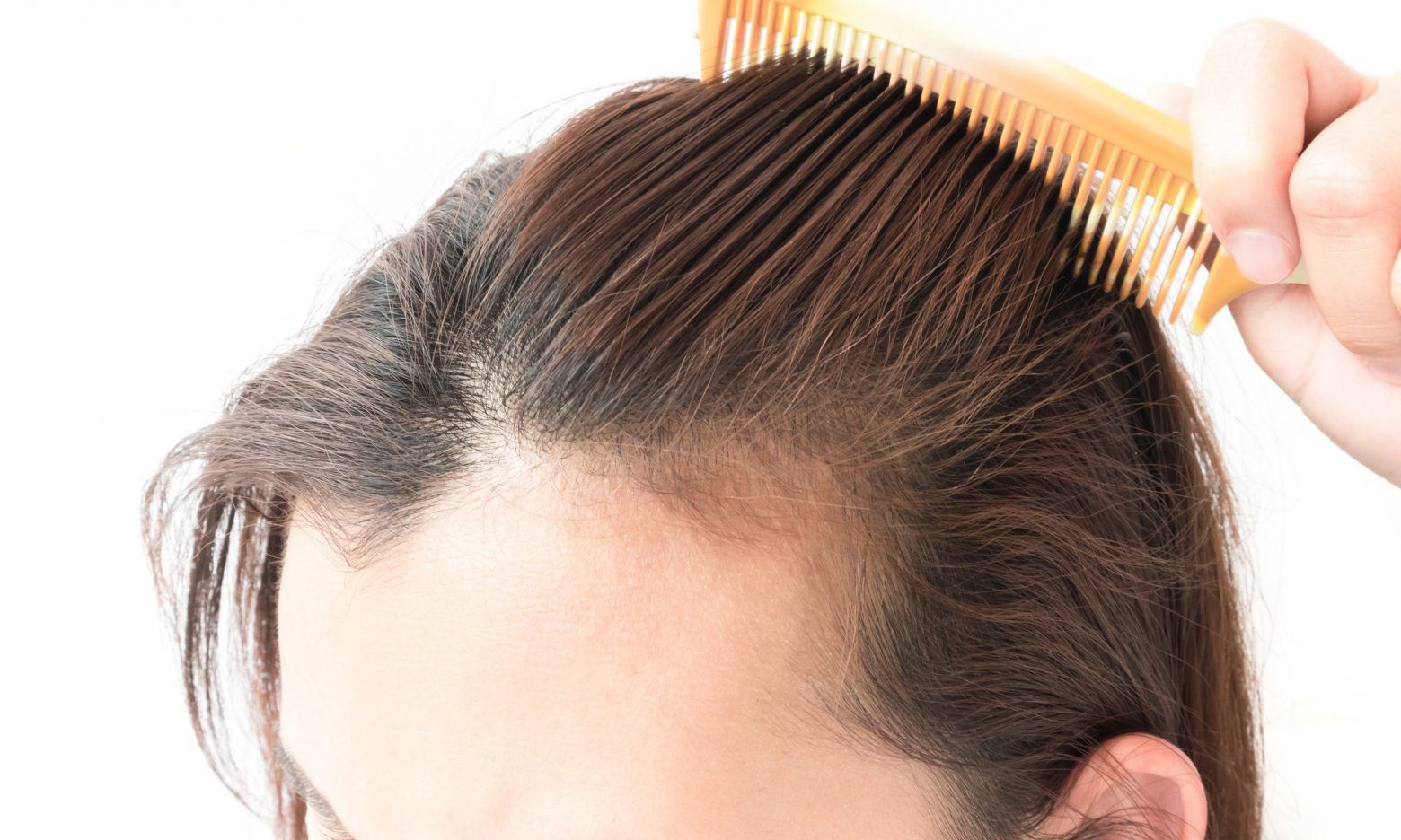 Signs and symptoms of hair loss – Hair Topper Trends
